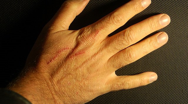 OUCH: Man cut off his right hand in failed ploy for insurance money ...