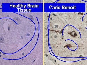 Chris Benoit Brain Scan