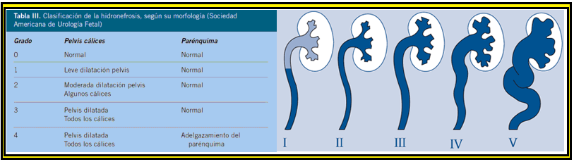 Bloc d´un Metge de Família: Hidronefrosi: coneix la seva Classificació ...