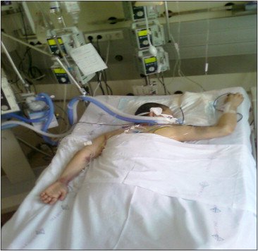 Prone Position Ventilation