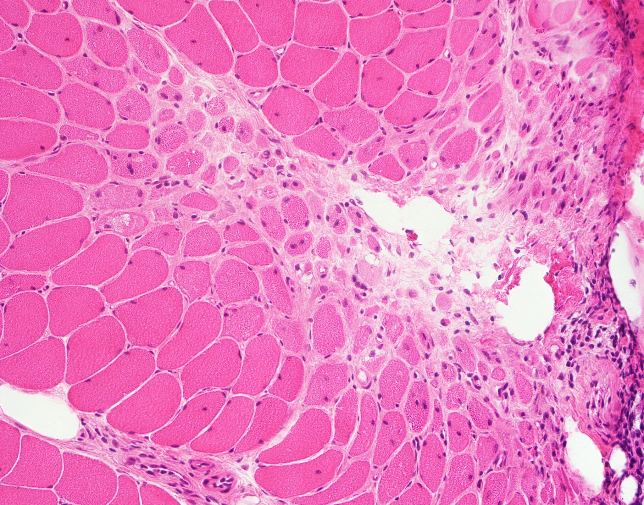 Perifascicular Atrophy