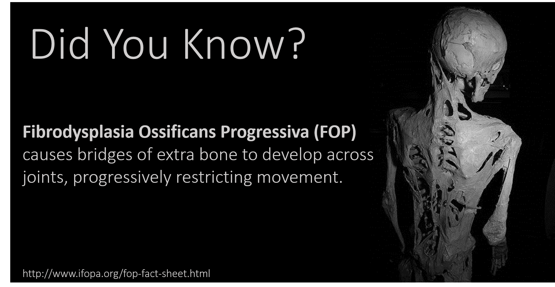 Fibrodysplasia Ossificans Progressiva