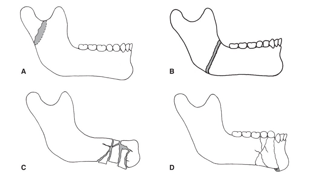Mandible Fracture Classification