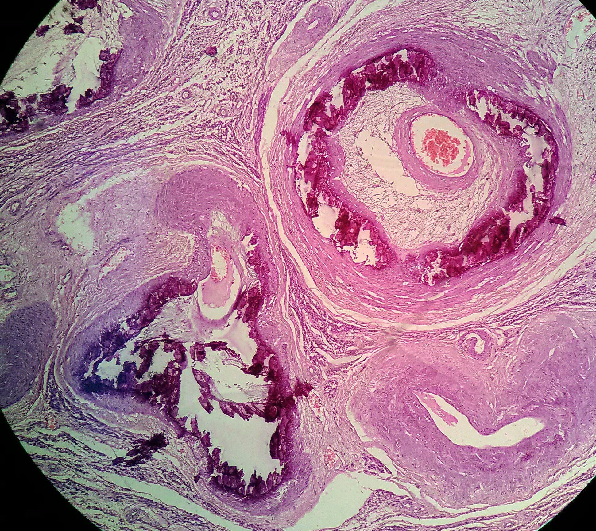 Monckeberg Arteriosclerosis