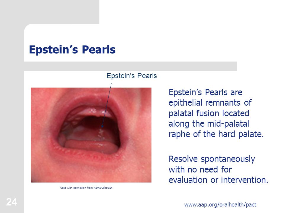 Epstein S Pearls