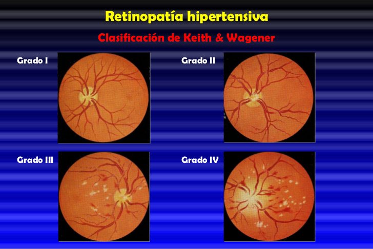 Retinopatía Hipertensiva Grado 1