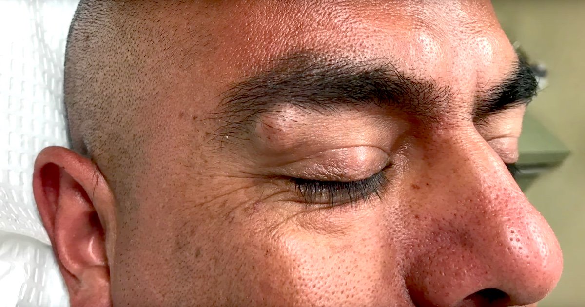 Dr Pimple Popper Squeezes A Plump Cyst On A Guy s Eyebrow And Magic dr-pimple-popper-squeezes-a-plump-cyst-on-a-guy-s-eyebrow-and-magic
