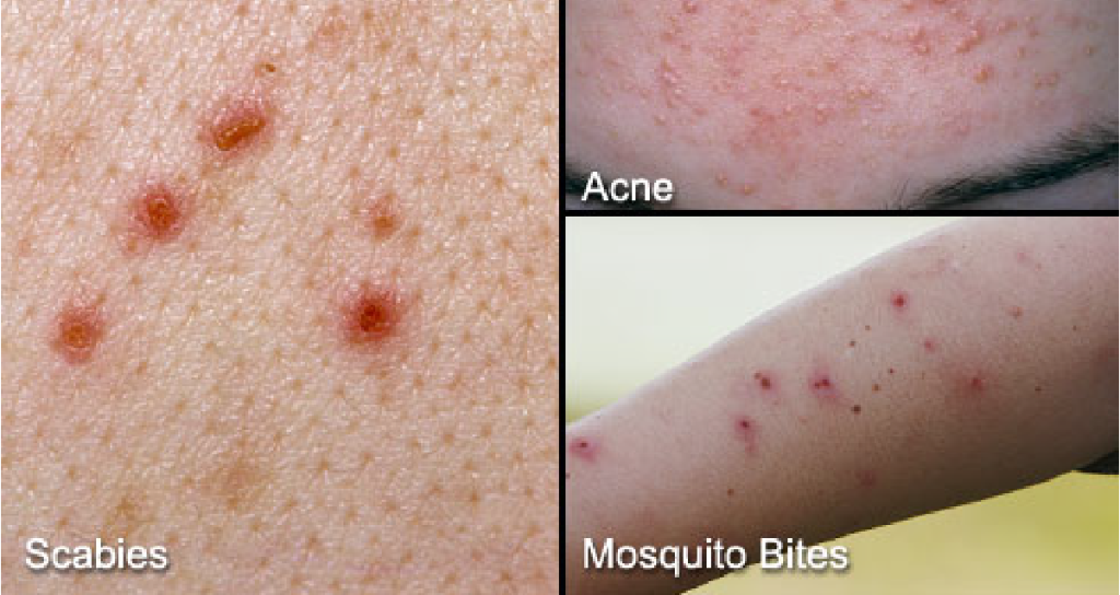 Scabies Bites