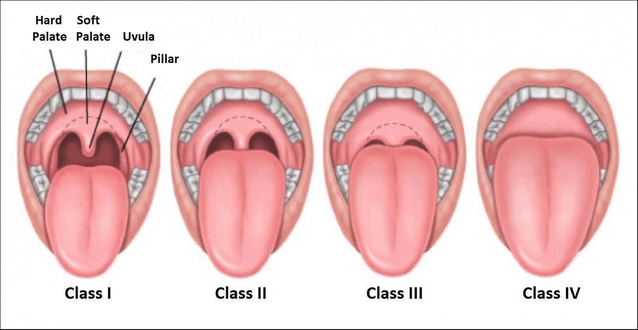 Uvula Swollen Tonsils, Adenoids, And Uvula