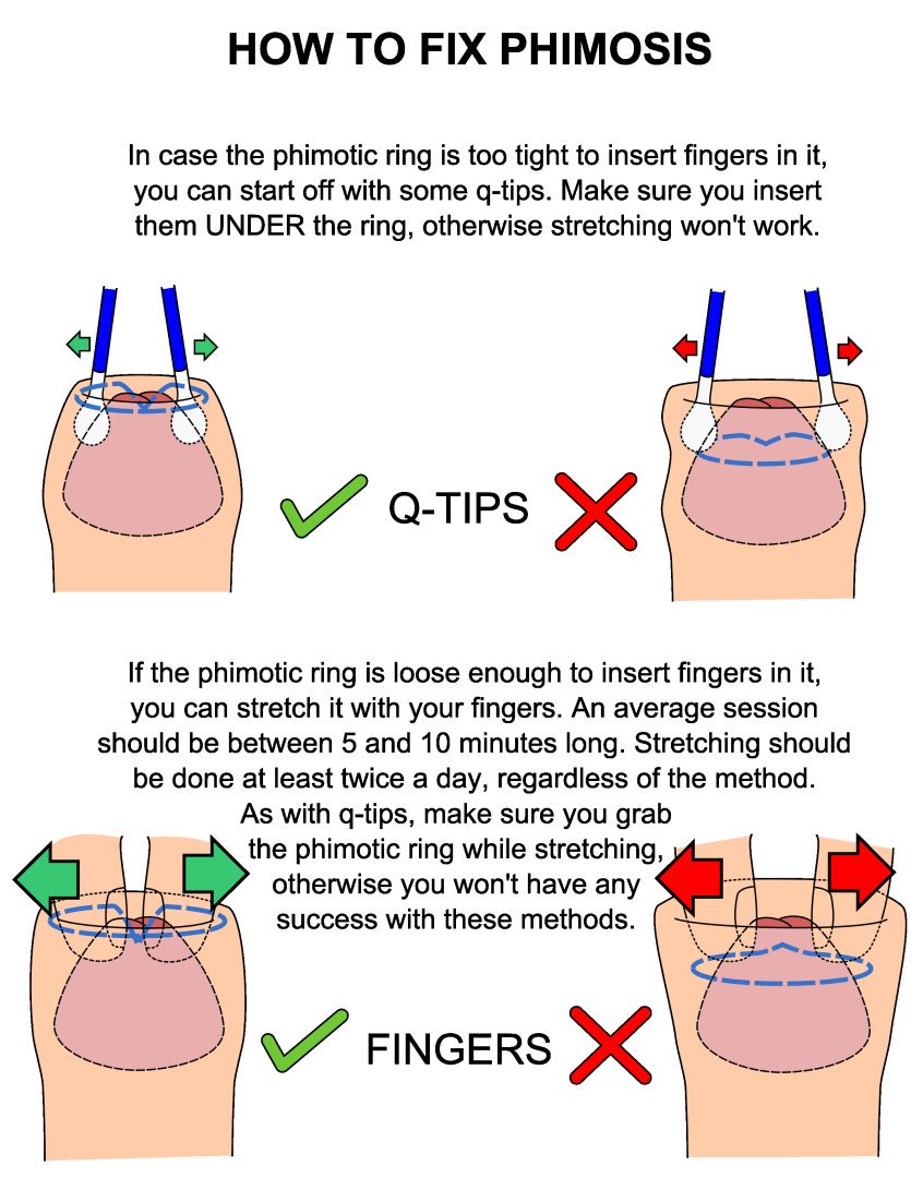 Phimosis Journey On Twitter Great Diagram Of Using The Q Tip Method