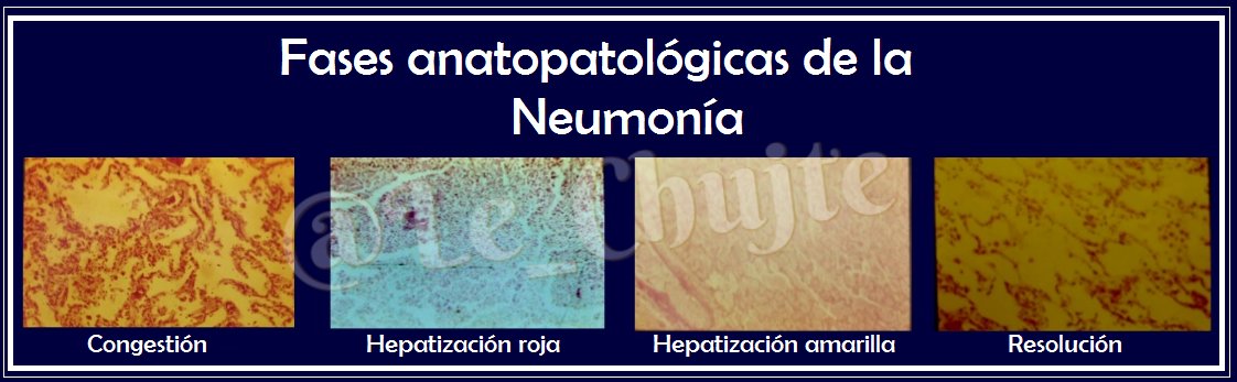 Etapas De La Neumonia Lobar