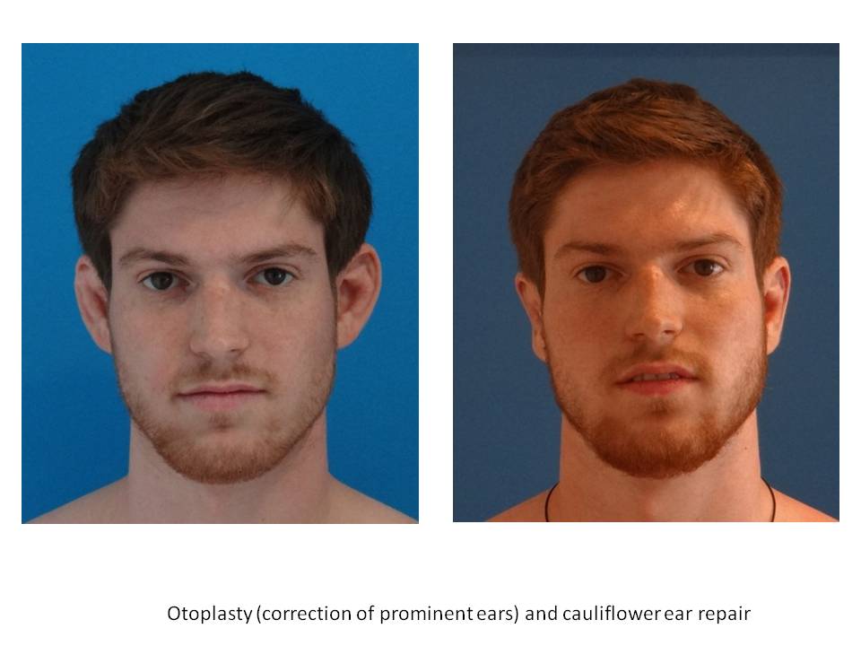 Cauliflower Ear After Surgery