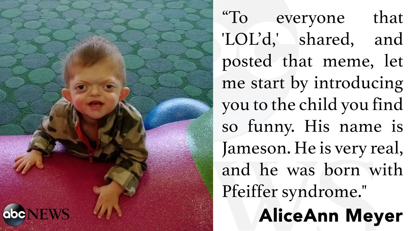Pfeiffer Syndrome Kid Memes It's Hip To Be Rare. Happy Rare Disease
