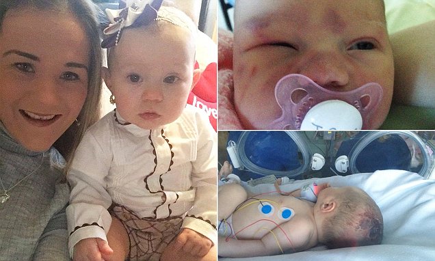 A baby delivered by forceps was born with 'black and blue' bruises and ...