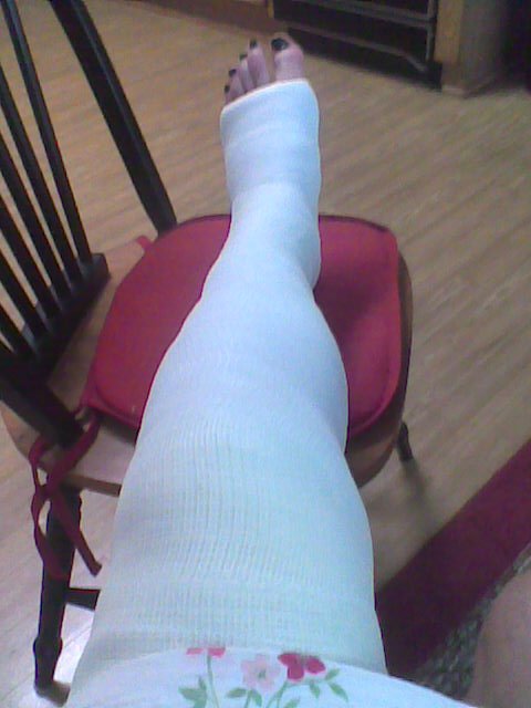 Fractured Fibula Cast