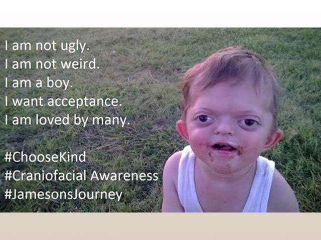 Pfeiffer: Mom defends son with Pfeiffer syndrome against offensive ...