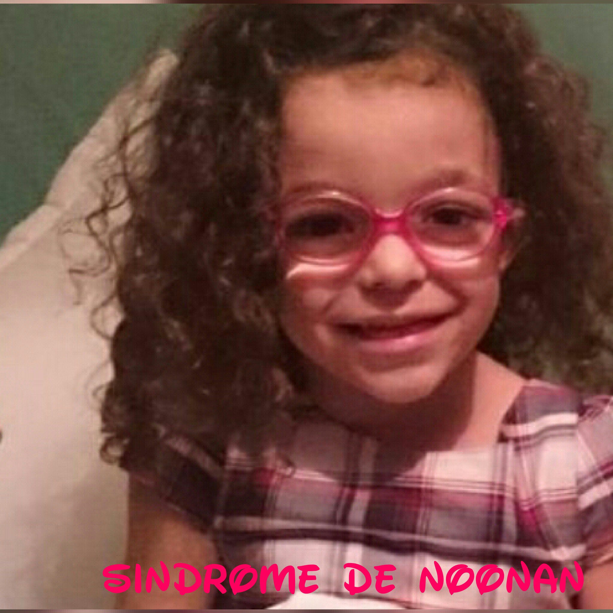 Sindrome De Noonan Adultos