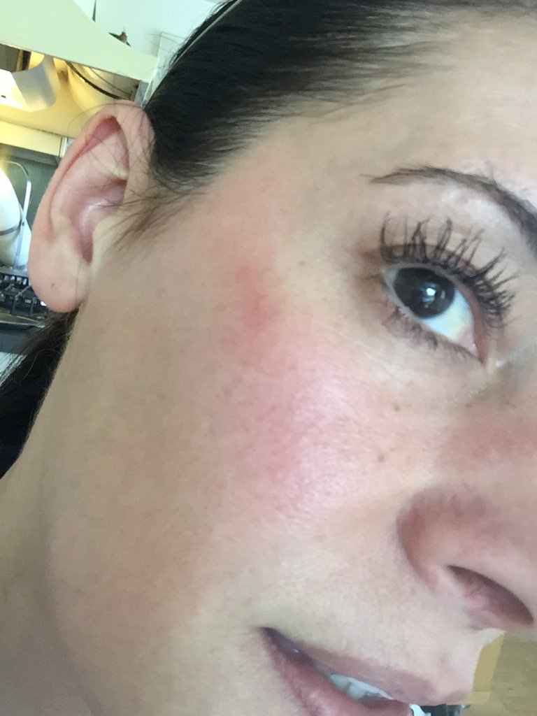 Gunshot Wound Healed