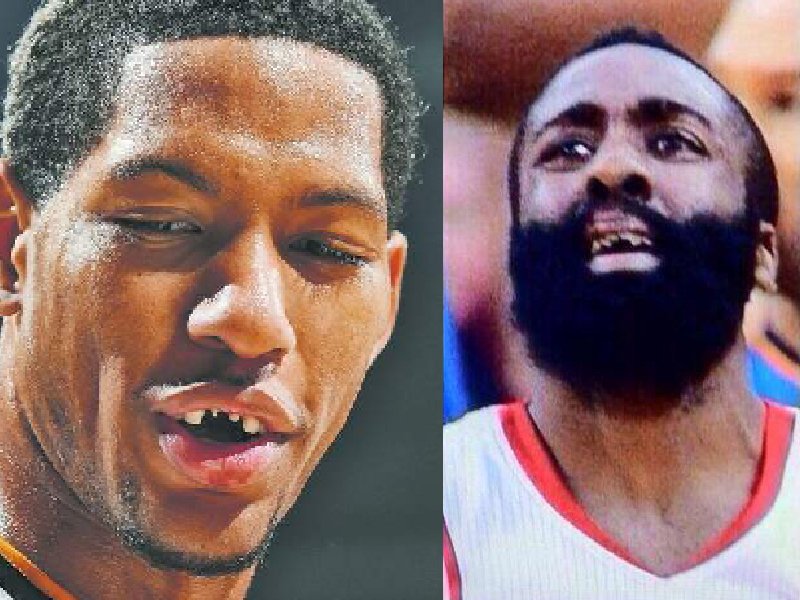 Worst Teeth In The Nba