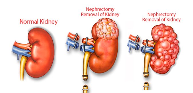 LS / HALS nephrectomy : 네이버 블로그