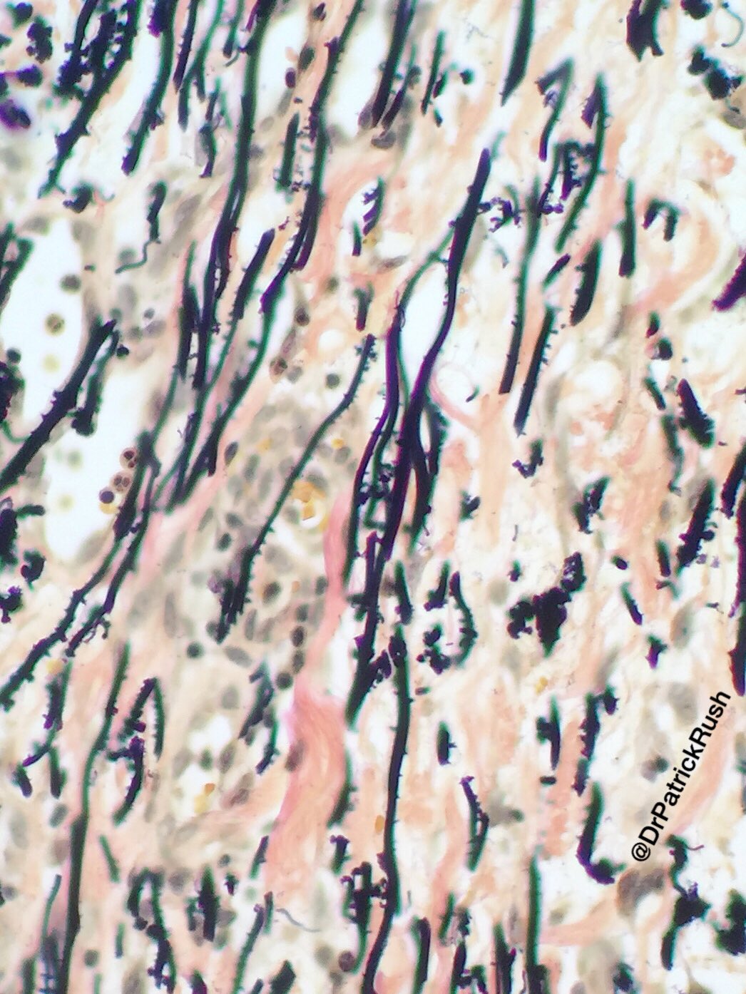 Elastosis Perforans Serpiginosa