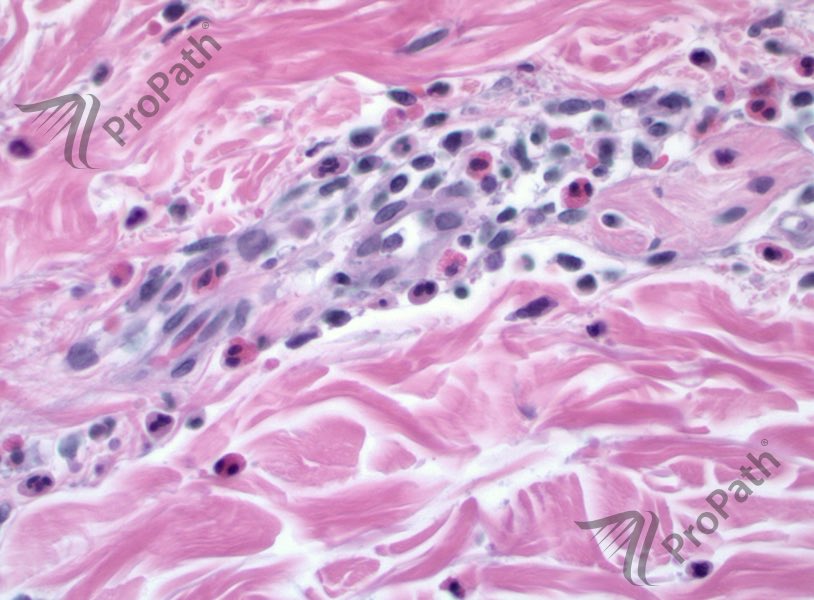 Urticarial Vasculitis Histology Sneddon Syndrome Associated With