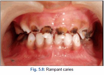 Rampant Caries How Long Can A Cavity Go Untreated? O2 Dental Group
