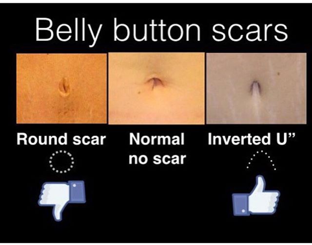 Belly Button Shapes