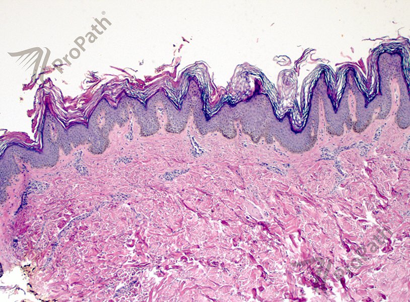Confluent And Reticulated Papillomatosis Pathology