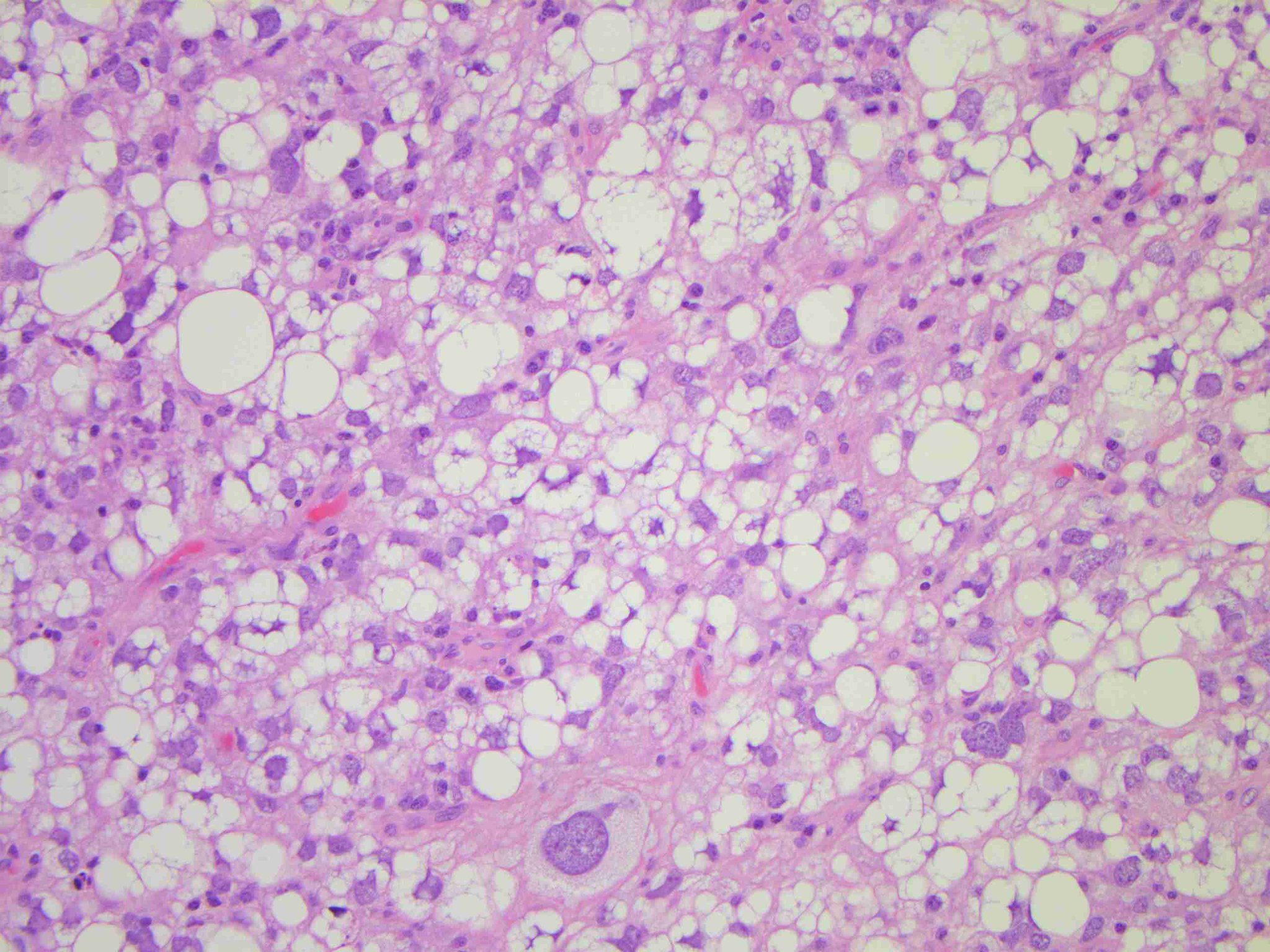 Liposarcoma