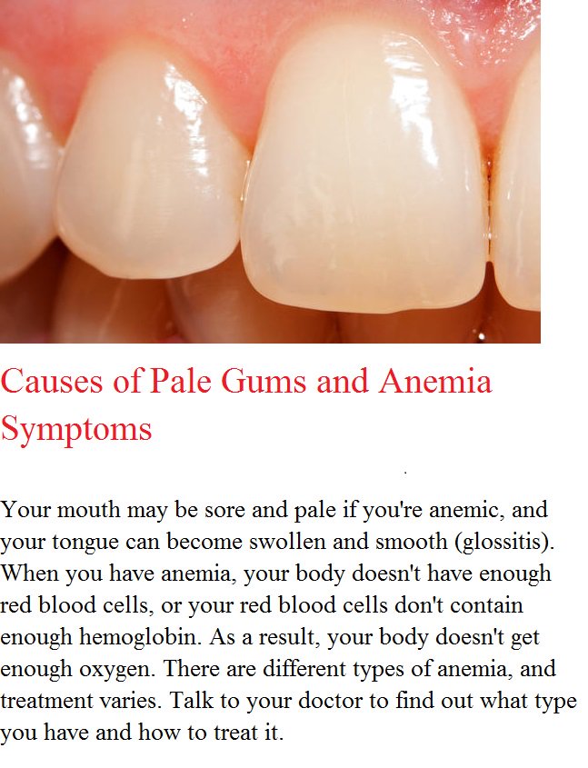 Pale Gums Anemia