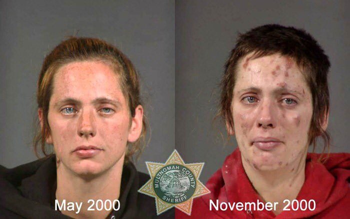 Heroin Addicts Before And After