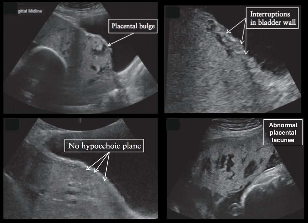 Abnormal Placenta Ultrasound Images