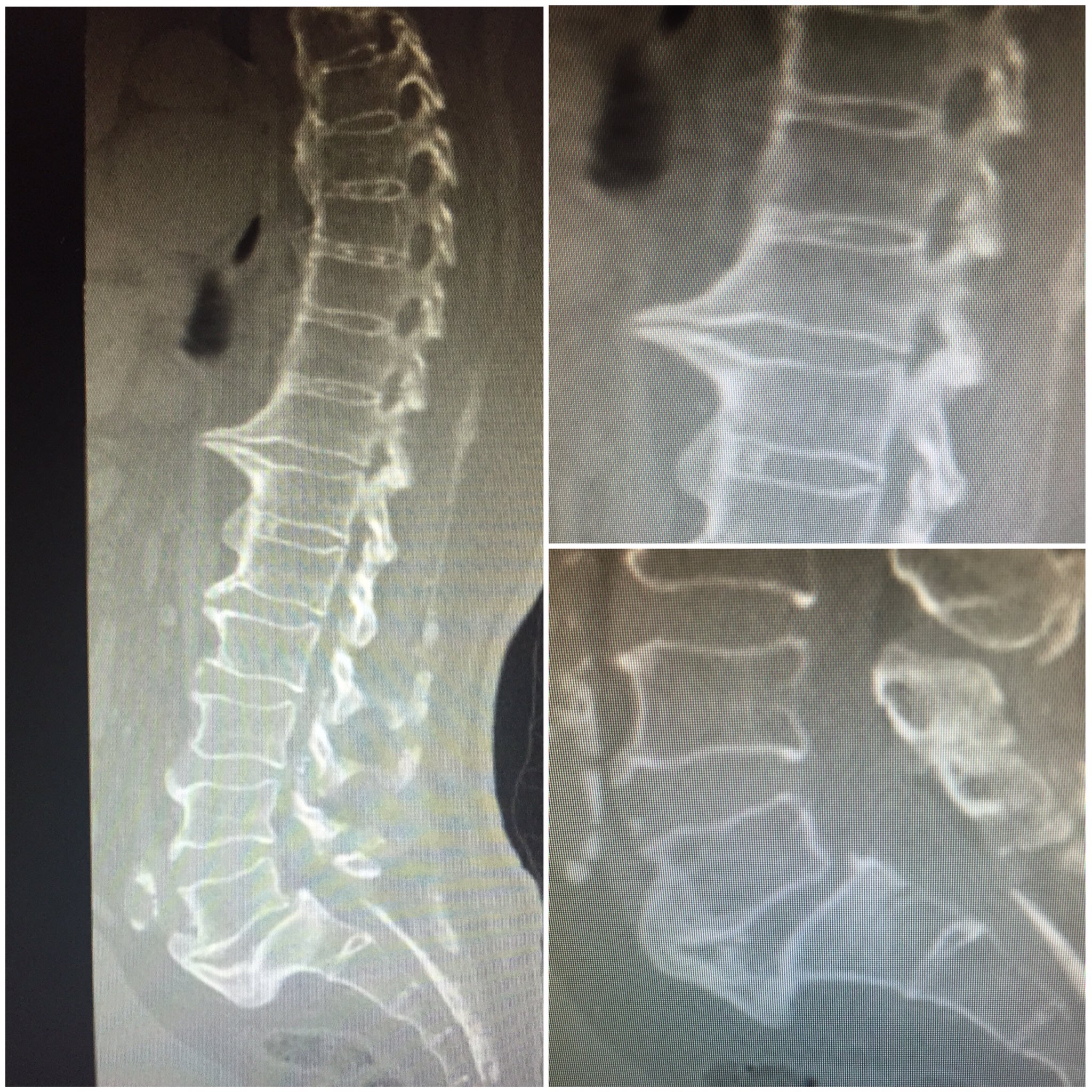 Que Es Osteofitos | My XXX Hot Girl