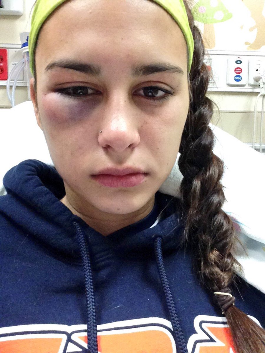 Black Eye From Punch