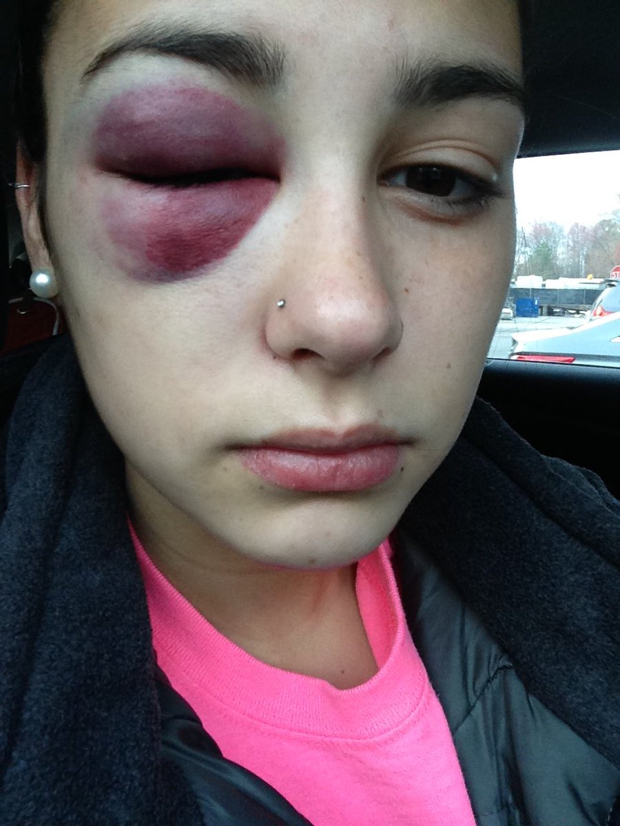 Black Eye From Punch