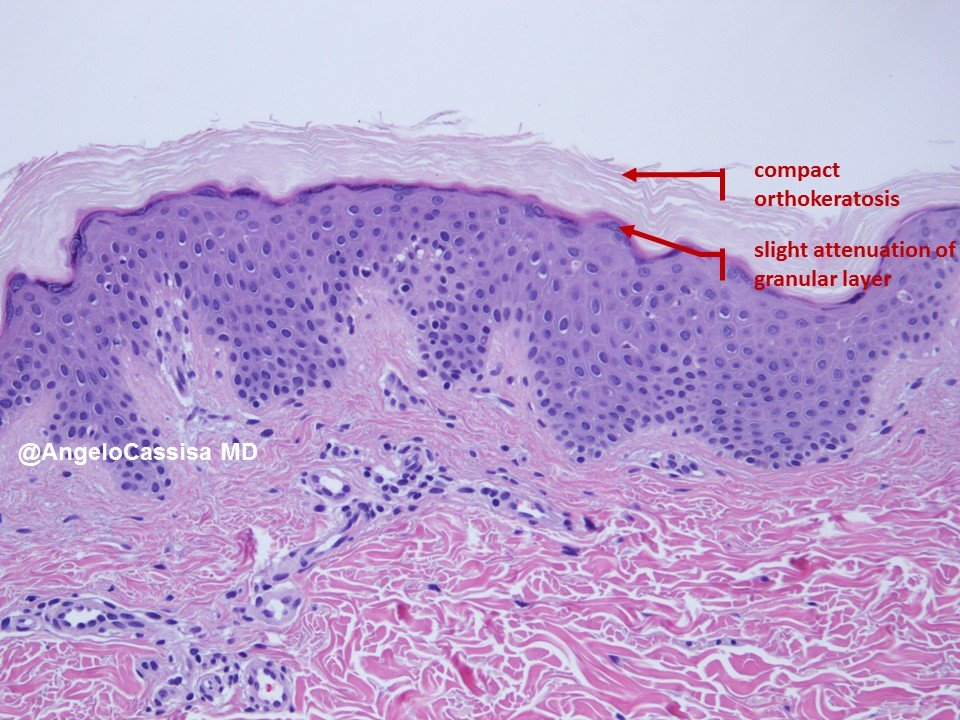 Ichthyosis Vulgaris Histology