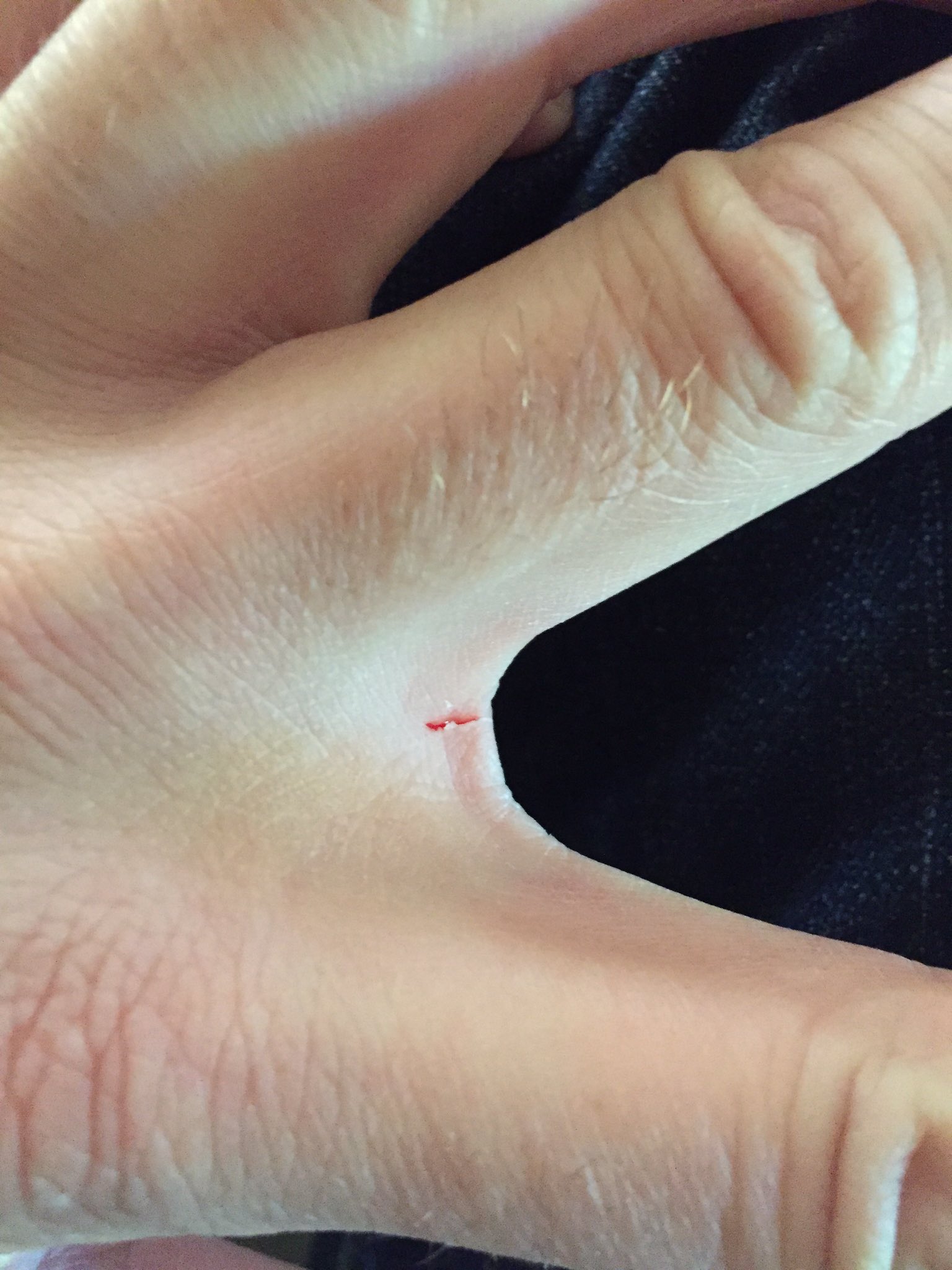 Webbing Between Fingers