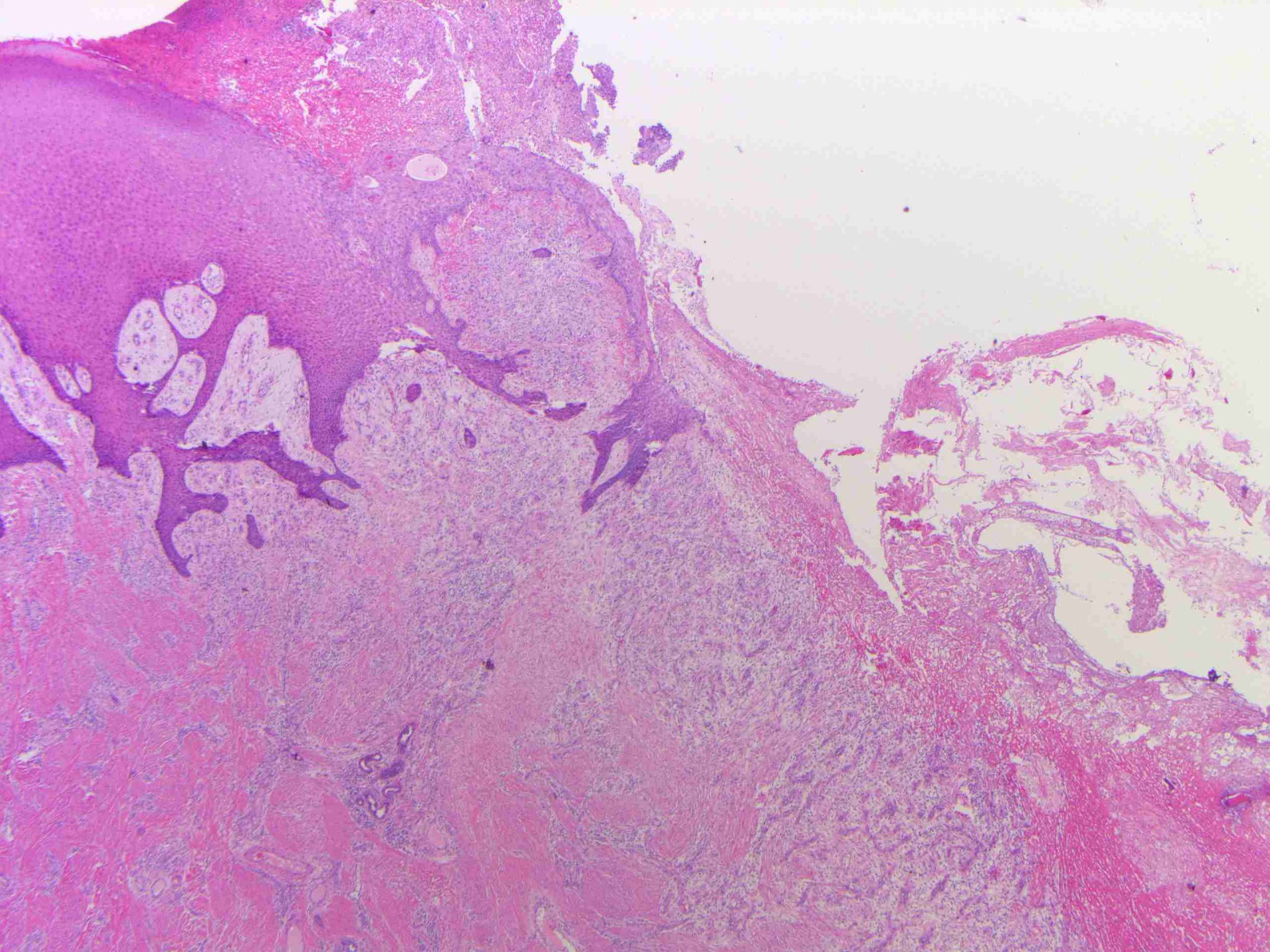 Skin Ulcer Histology