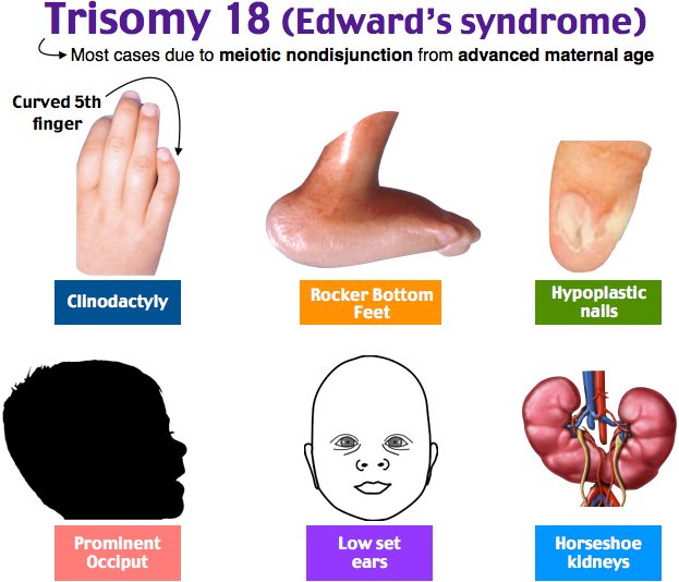 Rocker Bottom Feet Trisomy 18