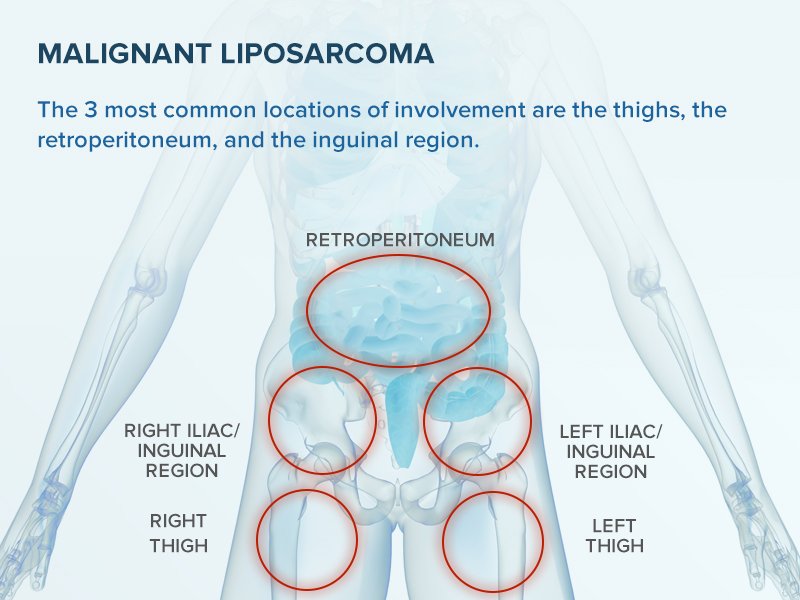 Liposarcoma