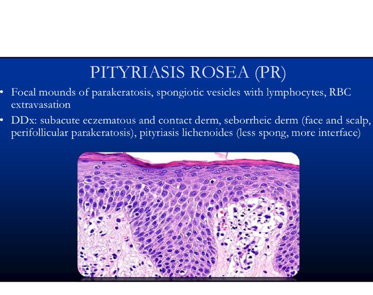 Parakeratosis Histology