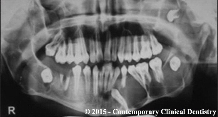 Basal Cell Nevus Syndrome Radiology