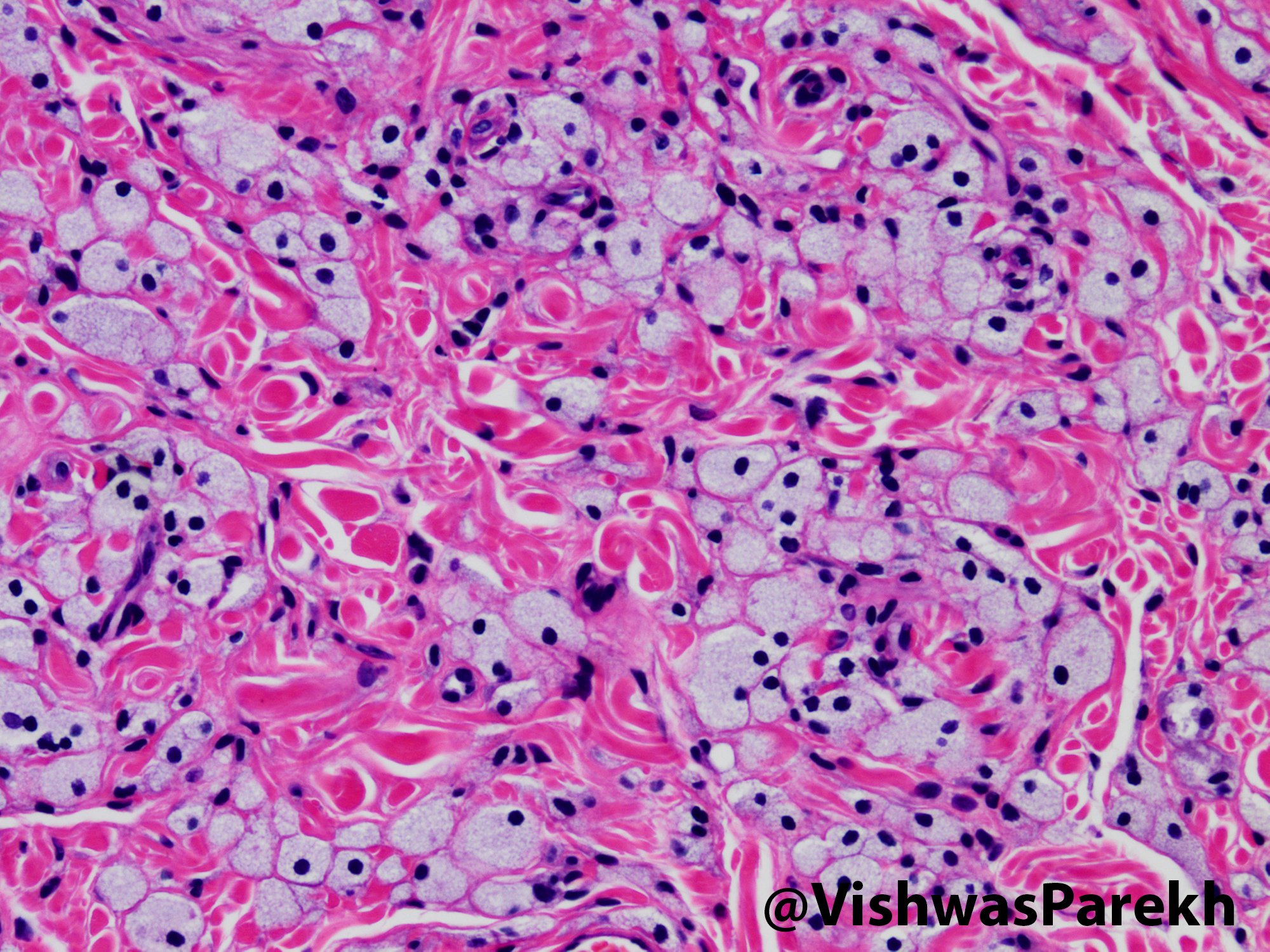Xanthelasma Histology
