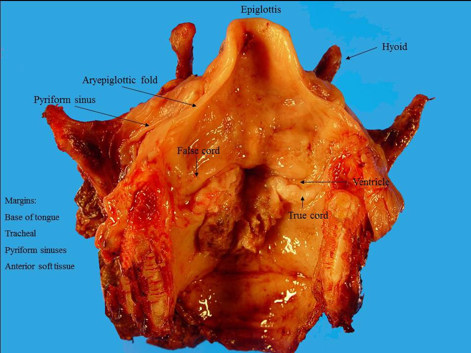 Total Laryngectomy Specimen