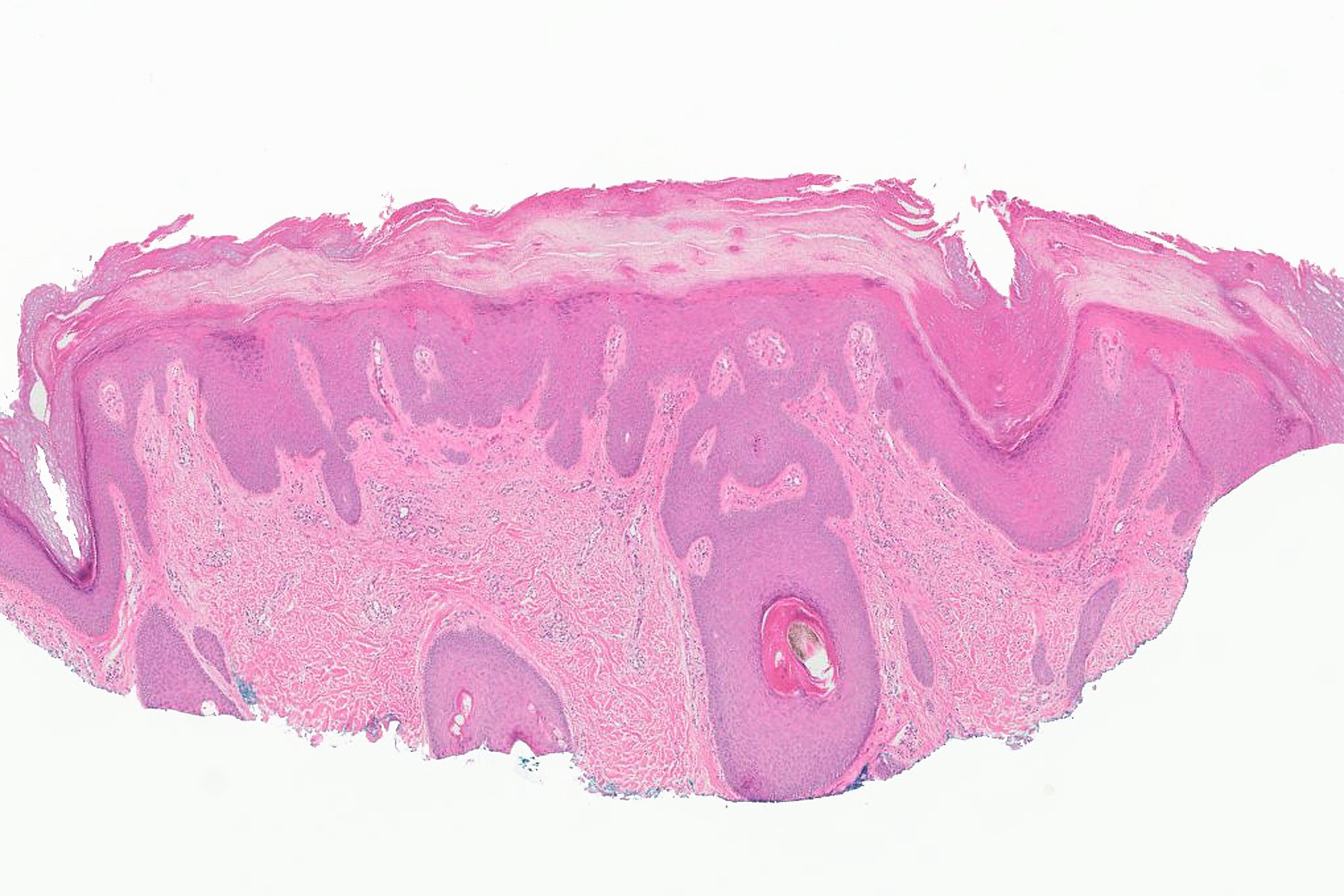 Lichen Simplex Chronicus Histology