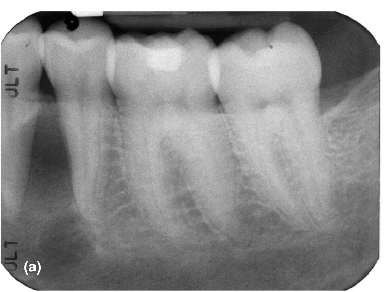 Lateral Periodontal Cyst