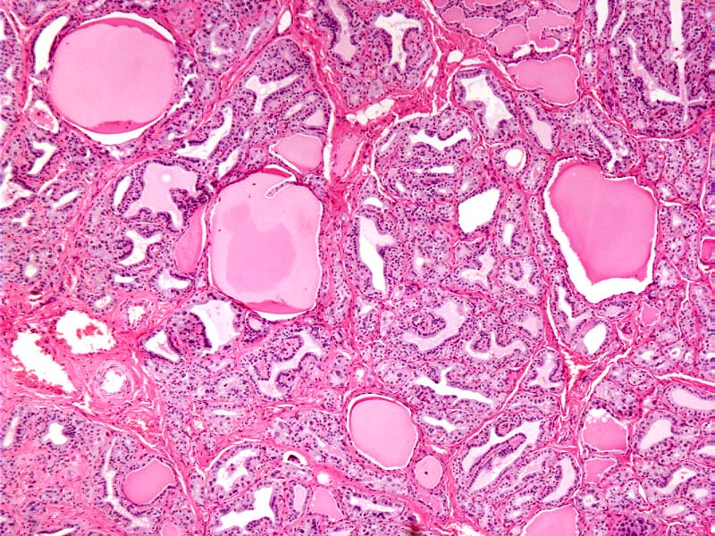 Pathology Outlines - Dyshormonogenetic goiter