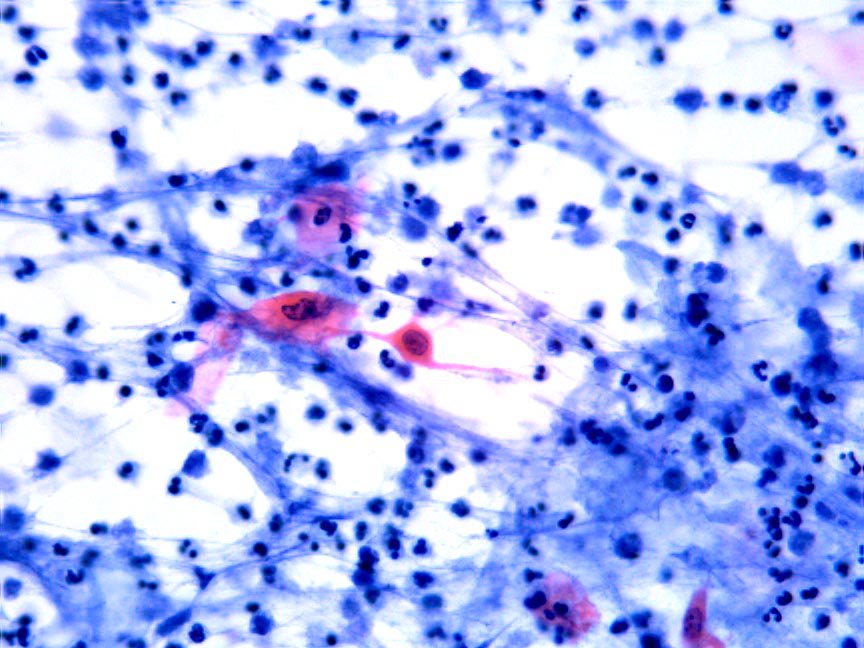 Branchial Cleft Cyst Cytology