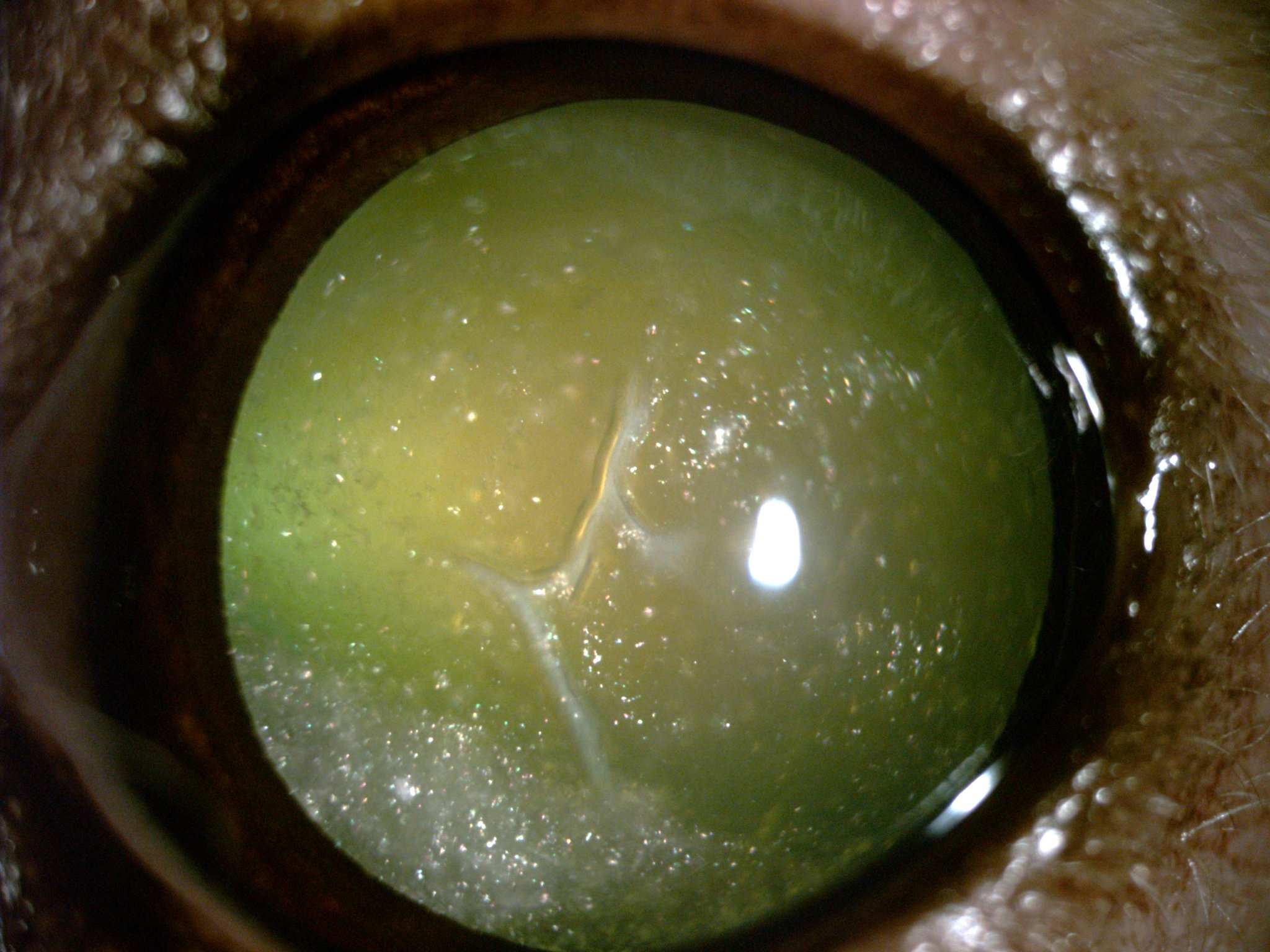 Hypermature Cataract